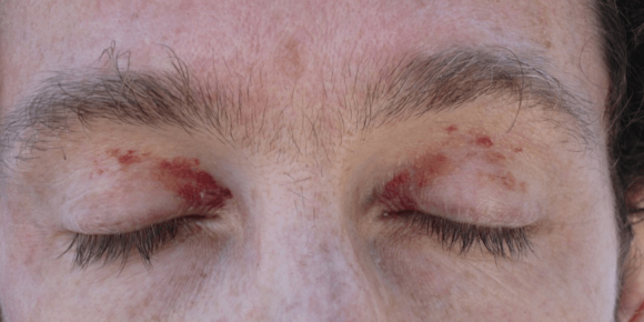 Crvene tačkice po tijelu - šta ih uzrokuje i na šta upućuju ...